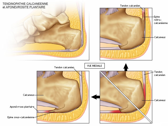 Common Sore Foot Culprits - gitabott’s blog