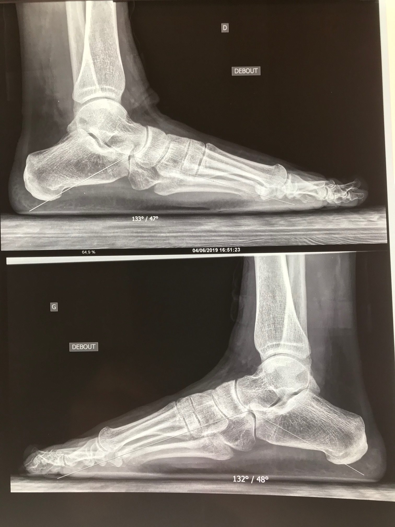 Pied Plat - Clinique du pied