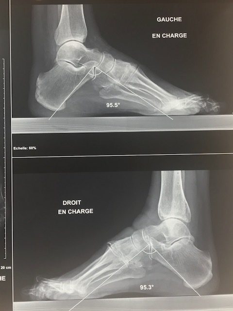 Pied Creux - Clinique du pied